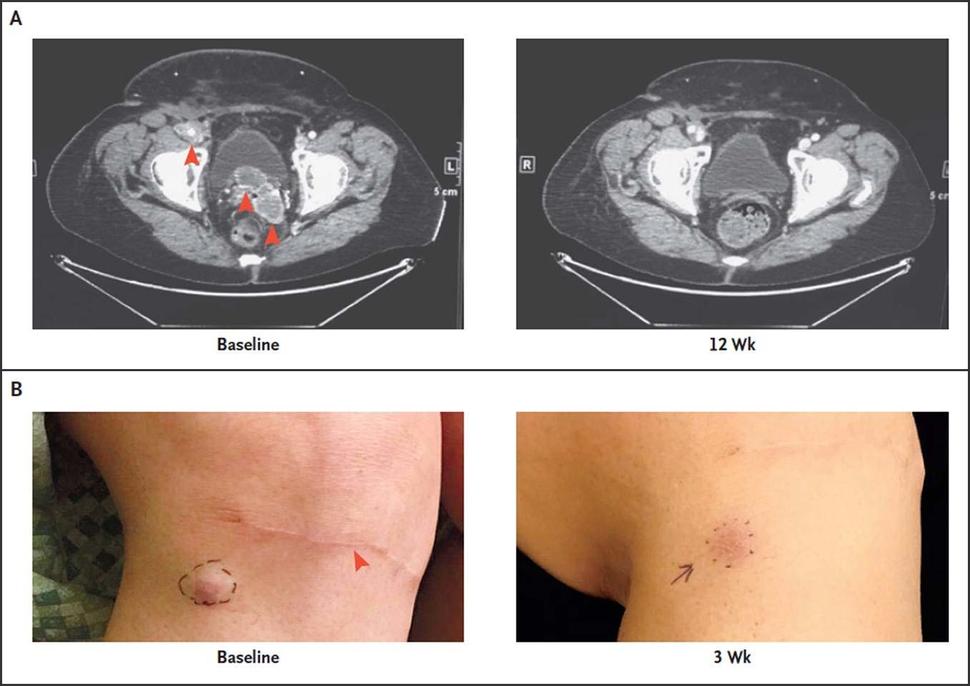 Transforming Merkel Cell Cancer Treatment Through Groundbreaking ...
